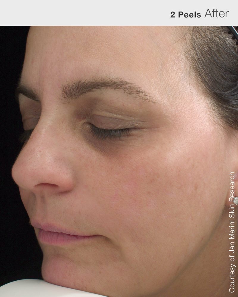 Jan Marini Transform Peel System - Glycolic Chemical Peels